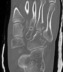 Cuboid Fractures | The Bone School